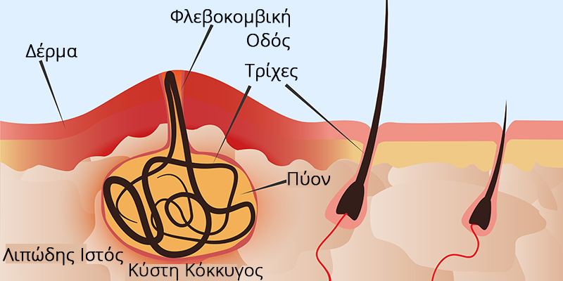Κύστη κόκκυγος: Συμπτώματα, Αίτια, Αντιμετώπιση Laser 15 λεπτά